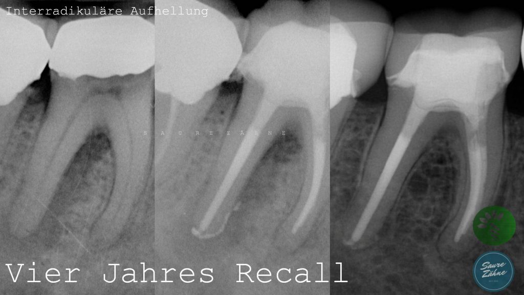 Interradikuläre Aufhellung - Saure Zähne - Zahnärzte Blog von und für ...